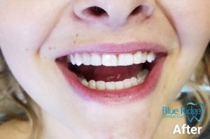 Smile Gallery - Blue Ridge Dental Care