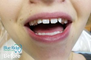 Smile Gallery - Blue Ridge Dental Care