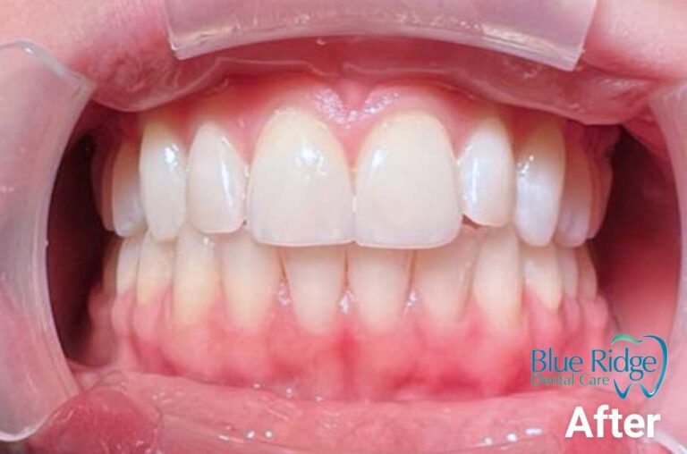 Smile Gallery - Blue Ridge Dental Care